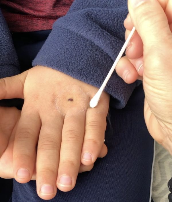 Easy Wart Treatment for Children | Dr. Vivi